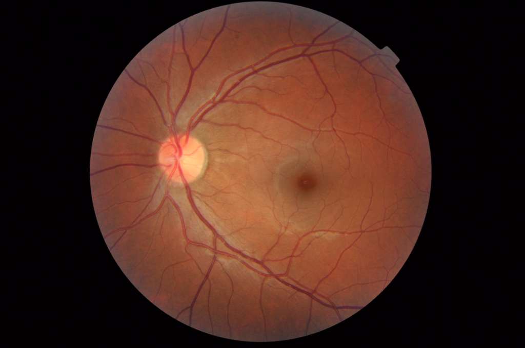 Eye Disease Management - Minoru Eye Clinic